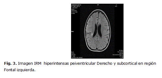 Neuritis óptica y Encefalomielitis diseminada aguda. Presentación de un ...