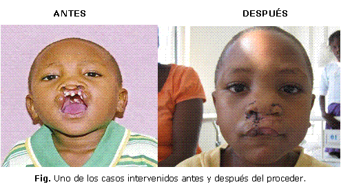 Fisura labio-palatina. Nuestra experiencia en 14 casos