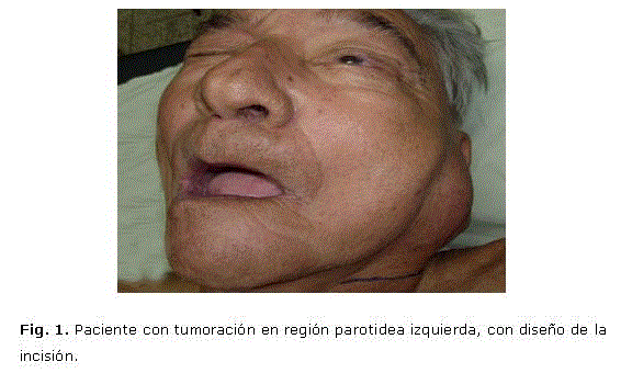 Tumor mucoepidermoide de la glándula parótida. Presentación de un caso