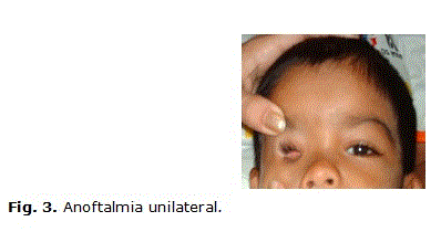 Anoftalmo congénito familiar | Pérez Fonseca | MULTIMED