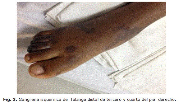 Gangrena simétrica periférica en una paciente con choque séptico ...